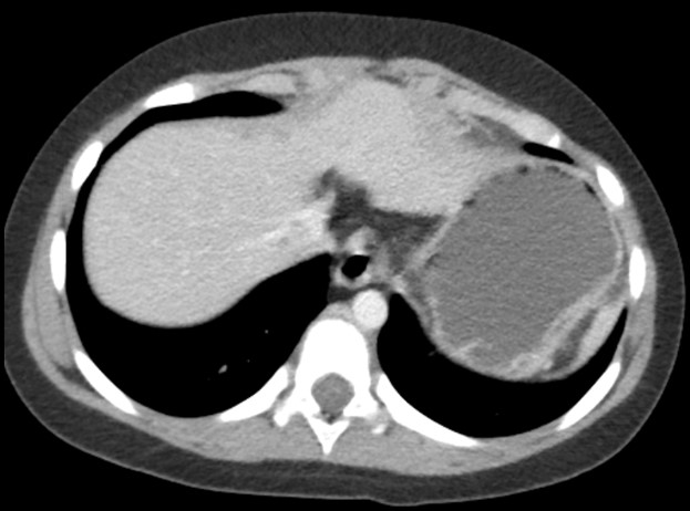 7-year-old male with chronic abdominal pain PMH: Asthma PSH: Tonsillectomy