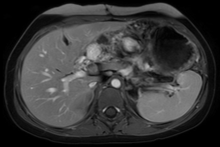 7-year-old male with chronic abdominal pain PMH: Asthma PSH: Tonsillectomy