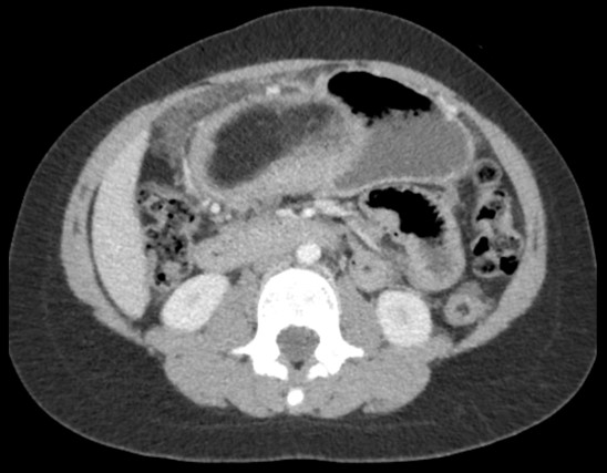 7-year-old male with chronic abdominal pain PMH: Asthma PSH: Tonsillectomy